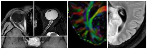 Imaging In Neuro Ophthalmology