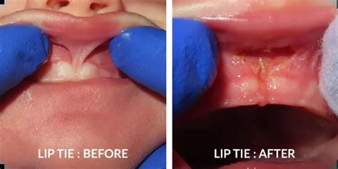 Infant Tongue And Lip Ties Center For Airway And Facial Development