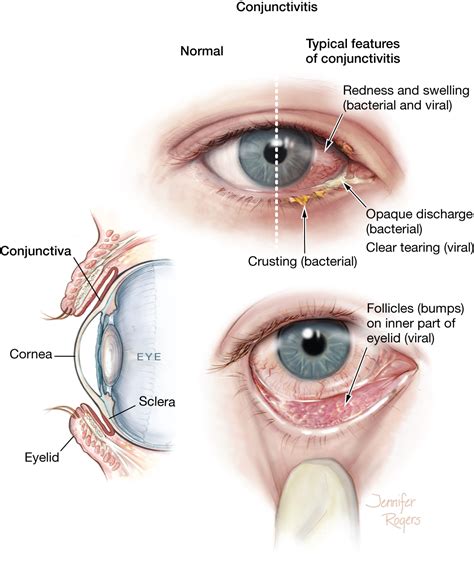 Conjunctivitis External Eye Disease Jama Jama Network