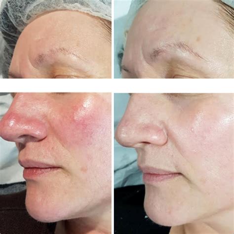 Acne Rosacea Before After