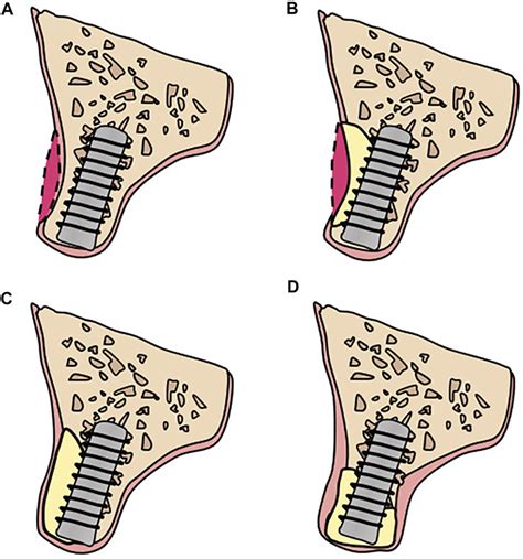 Bone Defects Classification A Class 1 Ideal Alveolar Bone