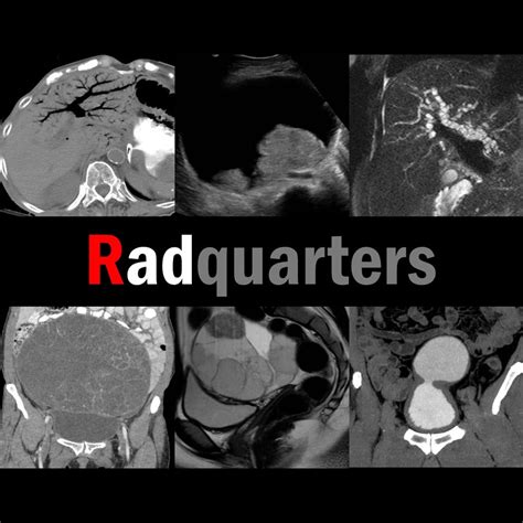Case Of The Week Ovarian Torsion Ultrasound Radiology Lectures