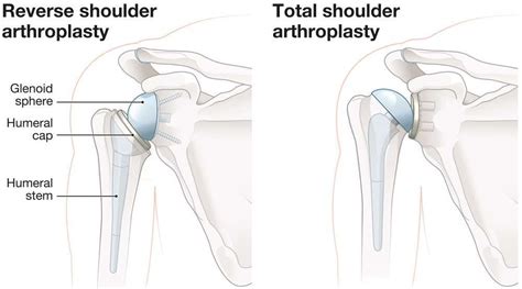 Shoulder Replacement Surgery Dr Bakul Arora