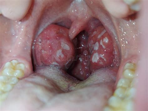 Healthy Normal Tonsils