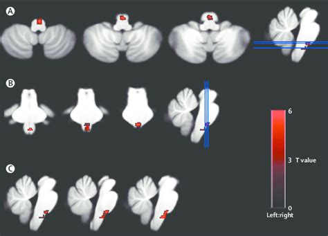 Voxel Based Morphometry In Sca1 Spm Maps Of Grey Matter Differences
