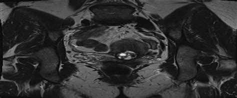 Mucinous Epithelium In Endometrial Curetting Leading To Diag