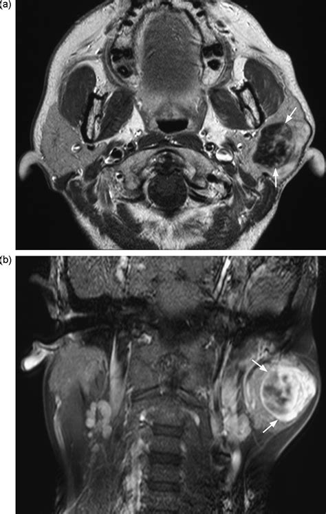 Salivary Gland Cancer X Ray Mucoepidermoid Carcinoma Of Salivary