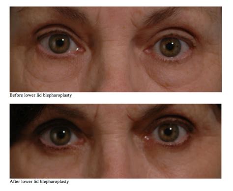 Blepharoplasty Eyelid Surgery Los Angeles And Beverly Hills