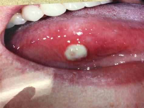White Spot On Tongue Cancer