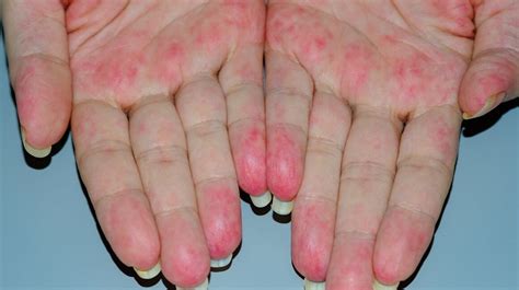 Vaskulitis Bolest Koja Se Maskira Kao Nešto Bezazleno