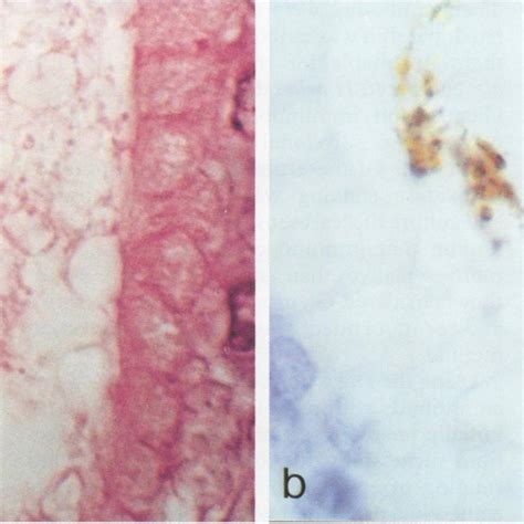 Pdf Detection Of Helicobacter Pylori In Gastric Biopsy And Resection
