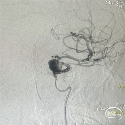 Time To Evolve 超越之旅 Surpass Evolve治疗外伤性假性动脉瘤一例及6个月随访 脑医汇