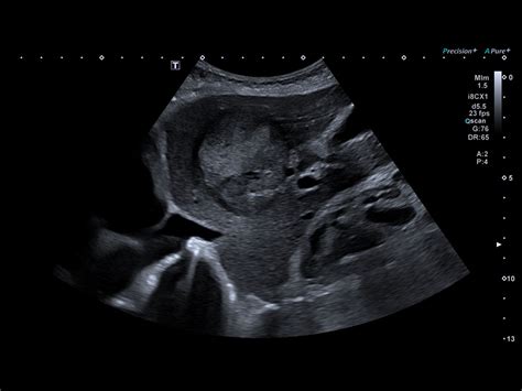 Abdomen Aplio I Series Prism Edition Clinical Gallery Ultrasound