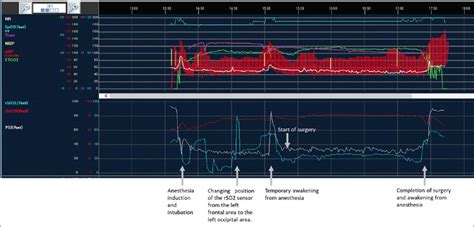 Abnormally Low Regional Cerebral Oxygen Saturation After Ind
