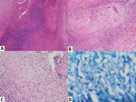 Histopathological Examination Of Resected Ileocecal Specimen Depicting