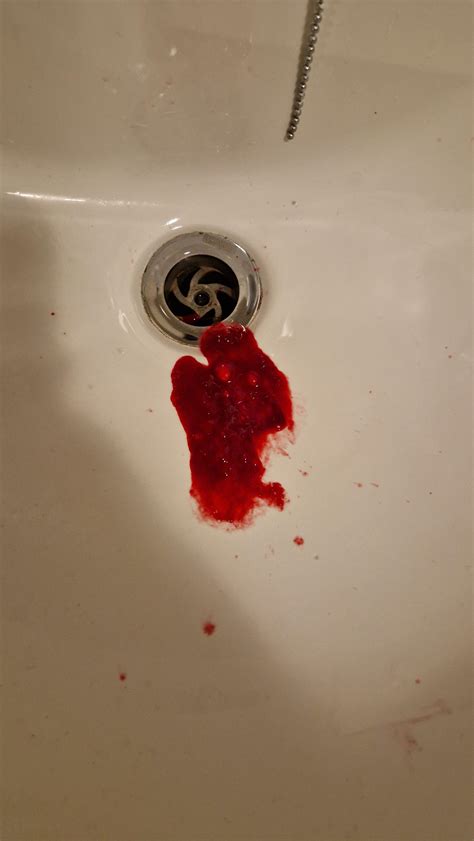 Pyoderma Gangrenosum On My Mothers Leg Rmakemesuffer