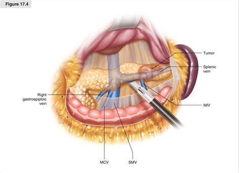 Laparoscopic Distal Pancreatectomy Oncohema Key