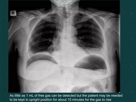 Pneumoperitoneum X Ray Pptx