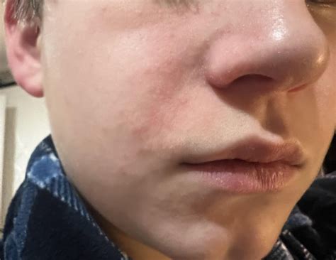 Facial Rash R Skincareaddicts
