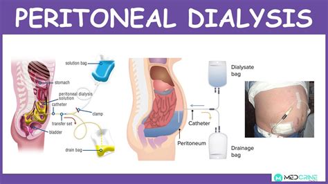 Peritoneal Dialysis Introduction Physiology Technique Modes And