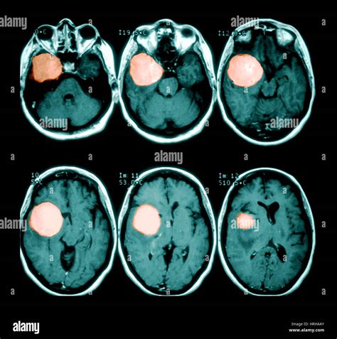 Tumeur Au Cerveau Photo Stock Alamy
