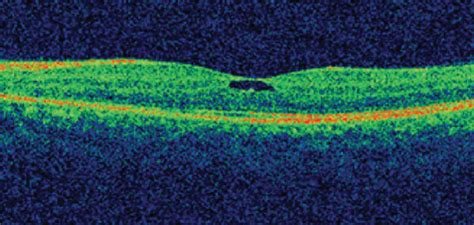 A L Serial Oct Scans Showing The Evolution Of Maculopathy Obtained Download Scientific