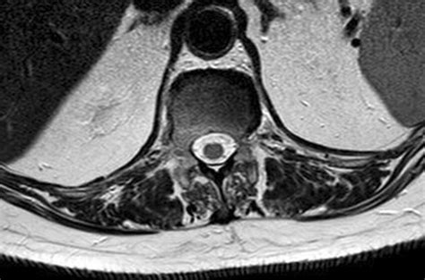 Axial T2 Magnetic Resonance Imaging Showing A Complete Resolution Of