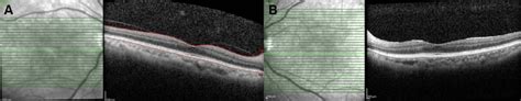 Optical Coherence Tomography Of The Macula At Presentation Download Scientific Diagram
