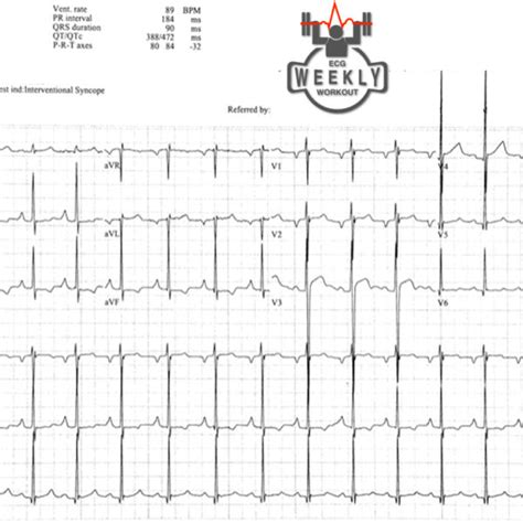 Athletes Ecg Ecg Weekly