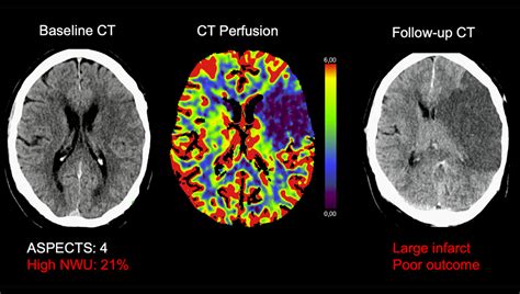 Stroke Thrombectomy May Work For Large Infarcts In The Late Time Window