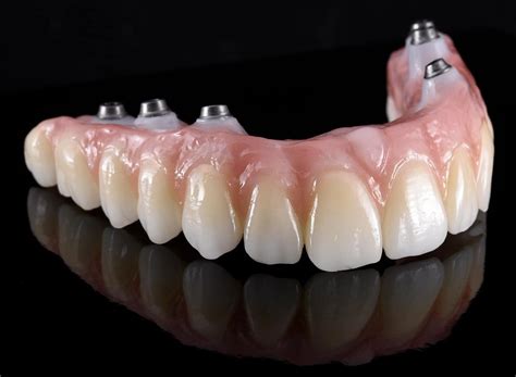 Dental Implants A Permanent Solution For Missing Teeth