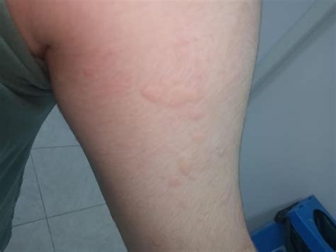Is This A Urticaria R Urticaria