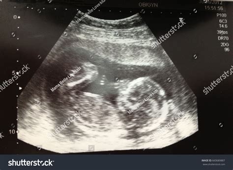 Pregnancy At 4 Months