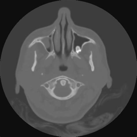 Ectopic Tooth In Left Maxillary Sinus Radiology Case