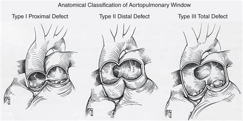 Aortopulmonary Window And Aortic Origin Of A Pulmonary Artery