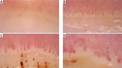 Systemic Sclerosis Multidisciplinary Disease Clinical Features And Treatment