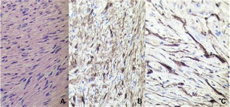 A An Avascular Spindle Cell Pattern With A Neuronal Component Is Seen