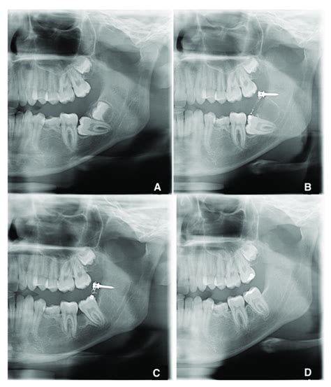 a d the whole radiographic sequence of intervention case 1 download scientific diagram