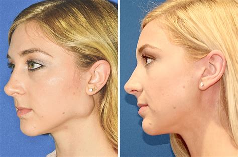 Superficial Parotidectomy