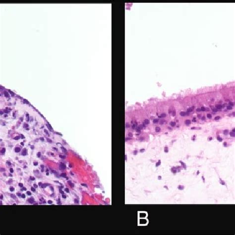 A Left Maxillary Sinus Exhibit Denuded Epithelium B Healthy Control