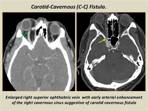 Presentation1 Radiological Imaging Of Cavernous Sinus Lesions