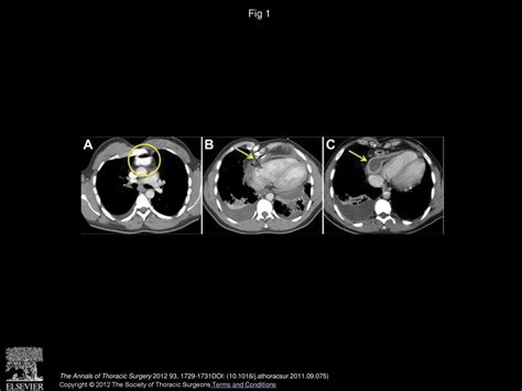 Elliot L Servais Md Brendon M Stiles Md Jason A Ppt Download
