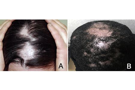 Hair Loss Types Alopecia Areata Signs And Symptoms