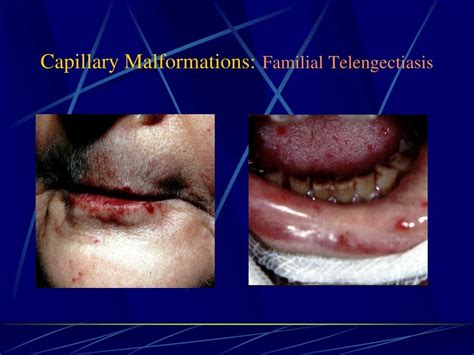 Ppt Vascular Anomalies Understanding Hemangiomas And Vascular