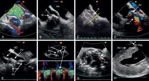 Intracardiac Echocardiography Thoracic Key