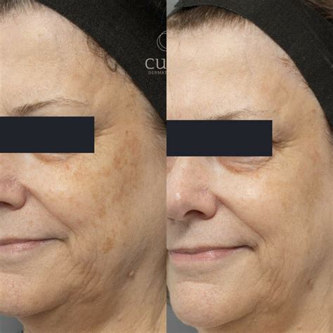Best Pico Laser Packages Brisbane Cutis Dermatology