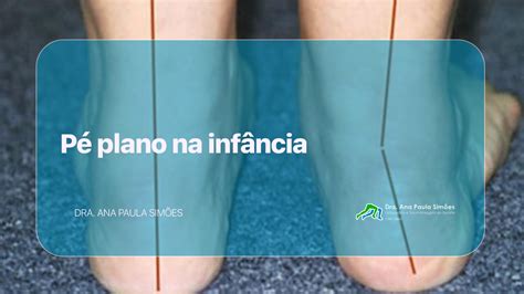 Pé Plano Na Infância Dra Ana Paula Simões Medicina Esportiva