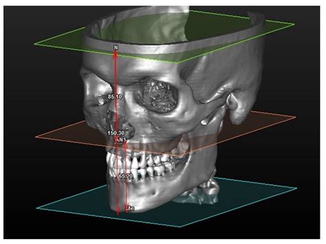 Anterior Nasal Spine Fracture