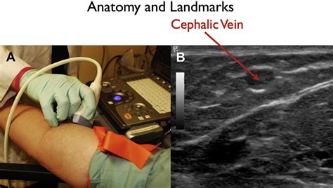 Ultrasound Guided Procedures In The Emergency Department—needle