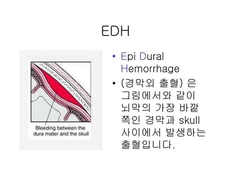 Ppt Edh Vs Sdh Powerpoint Presentation Id 6701929